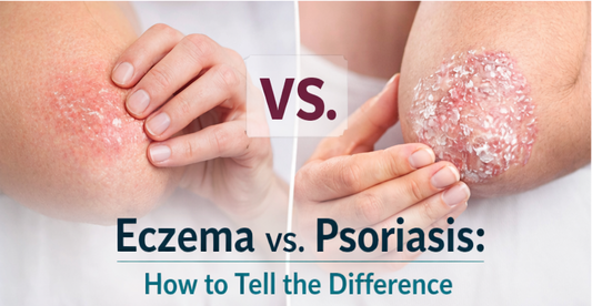 Psoriasis vs Eczema: How to Tell Them Apart