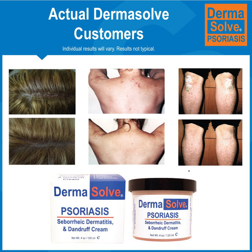 Dermasolve Psoriasis Cream